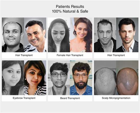 Acupuncture For Hair Loss How Will It Help In Hair Fall
