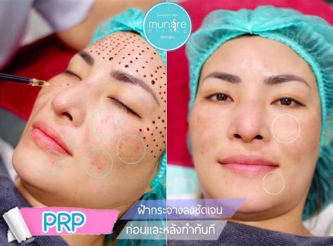 ตาหวานละมุน 💎 💎 โปร ซื้อ 1 แถม 1 💎 💎 การฉีด Prp คือ Facebook