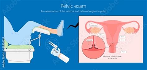 Cold Knife Cone Biopsy Loop Electrosurgical Excision Procedure Leep Large Loop Excision Of The