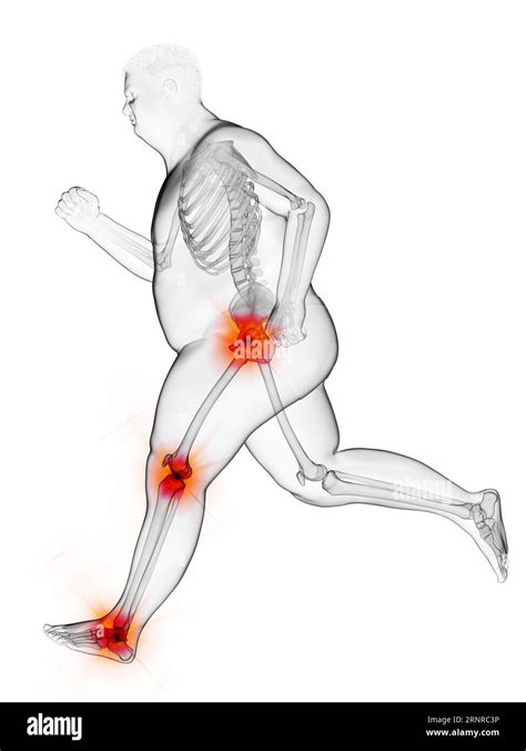 Obese Runner S Painful Joints Illustration Stock Photo Alamy