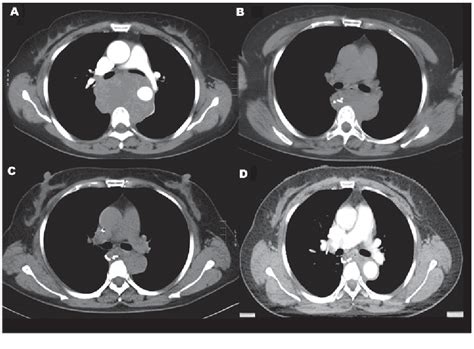 Figure 2 From Extraskeletal Ewings Sarcoma Primitive Neuroectodermal