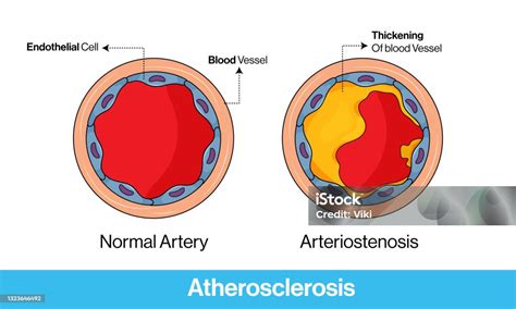 Ilustrasi Penyumbatan Pembuluh Darah Pada Aterosklerosis Ilustrasi Stok Unduh Gambar Sekarang