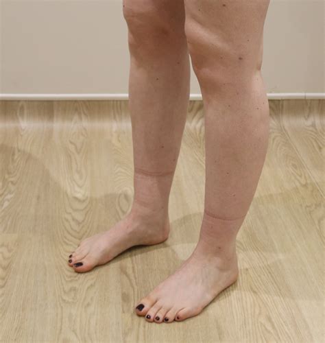 Cankle Surgery Gallery Kinvara Private Hospital