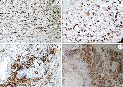 Immunoexpression Of Aldh1 In Mesenchymal Cells In Cystic Capsules And