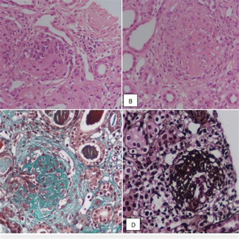 Class Ii Lupus Nephritis A Hematoxylin And Eosin Staining At ×400