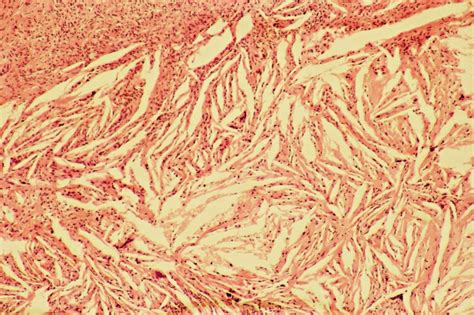 Increasing Estrogen Concentrations Reduces Cholesterol Expansion With Crystallization