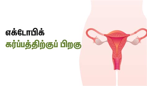 எக்டோபிக் கர்ப்பத்தின் வகைகள் என்ன Types Of Ectopic Pregnancy In