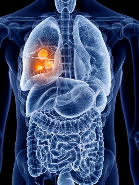 Lung Cancer Stock Illustration Illustration Of Bronchiolar 5564055