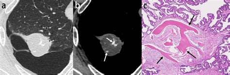 Stepwise Diagnostic Algorithm For High Attenuation Pulmonary Abnormalities On Ct Pmc