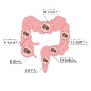 サクッとまるわかり大腸がん切除術後回盲部切除術結腸切除術の看護診断 なんでなんだナーシング