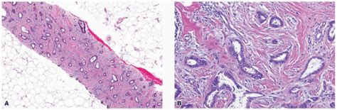 Tubular Carcinoma Basicmedical Key