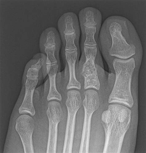 Lucentlytic Bone Lesion Differential Diagnosis Mnemonic Pacs