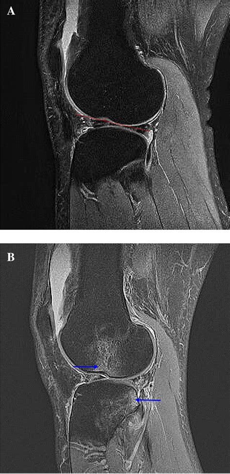 A Lateral Femoral Notch Sign B Kissing Contusion Ared Lines Show The