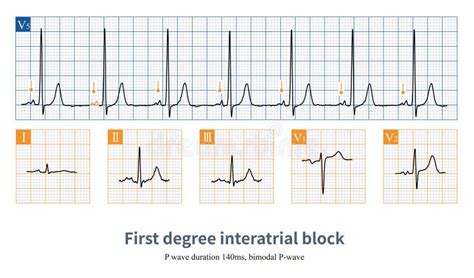 First Degree Interatrial Block Stock Illustration Illustration Of Anatomy Bundle 345699048 First Degree Interatrial Block Stock Illustration Illustration Of Anatomy Bundle 345699048