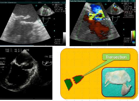 Acute Severe Structural Ischemic Mitral Regurgitation Due To Download Scientific Diagram