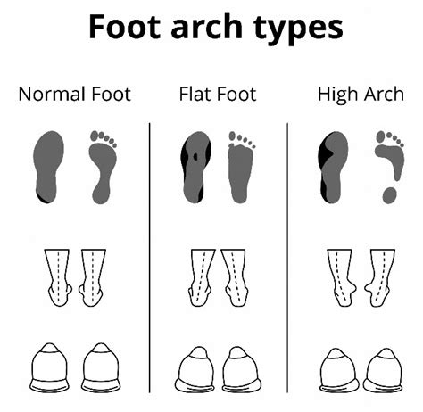 Types Of Foot Arches