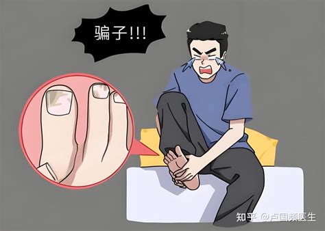 得了灰指甲，真能传染俩？医生：3类人更易染病，切勿盲目拔甲！ 知乎