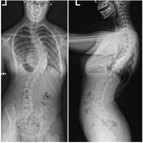 Understanding The Role Of Spine X Rays In Scoliosis Assessment