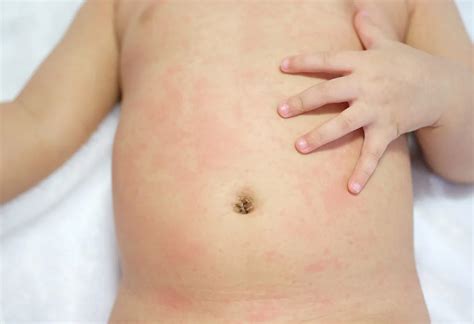Mild Heat Rash On Stomach