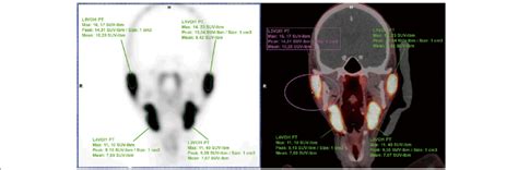 Measurements On Psma Uptake In Both Parotid Glands In A Patient Who Was
