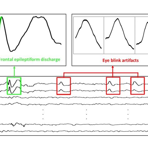 Frontal Epileptiform Discharges And Eye Blink From Chzu Database Download Scientific Diagram