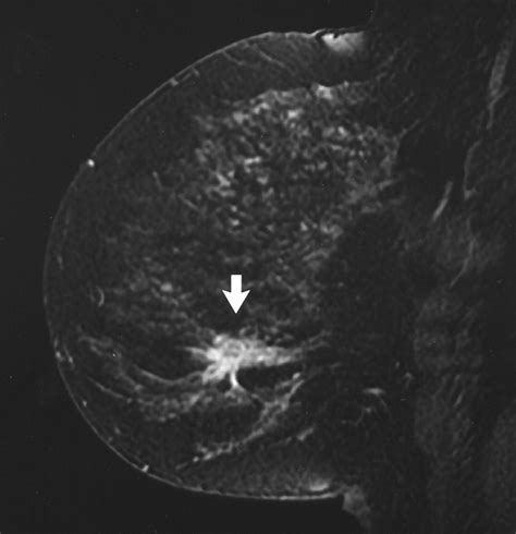 Breast Lesions Detected On Mr Imaging Features And Positive Predictive