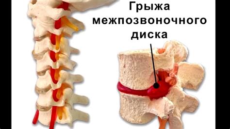 Ключевые термины на курсах костоправства!Что такое протрузия,экструзия ...