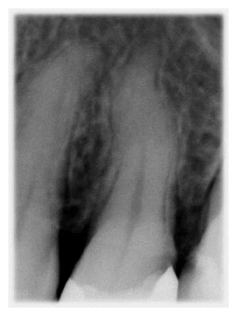 A Initial Radiograph B Working Length Radiograph And C Final