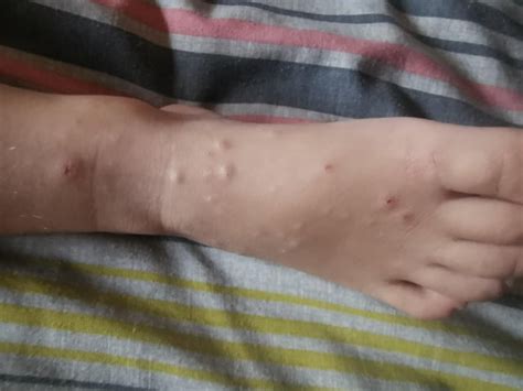 Awaiting Biopsy Results R Dermatologyquestions