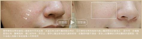 外泌體是什麼？可以在醫美診所使用嗎？優勢分級：人類外泌體！︱米蘭時尚診所
