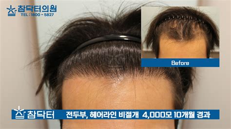 남자의 스타일은 헤어라인이 완성 빼곡촘촘하게 채워진 M자탈모는 자신감의 완성 남자의 스타일은 헤어라인이 완성 빼곡