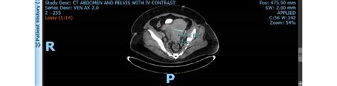 Endometrial Thickening Up To Cm And Heterogeneity Download Scientific Diagram