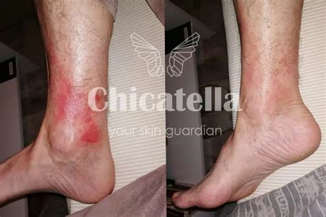 Atopijski Dermatitis