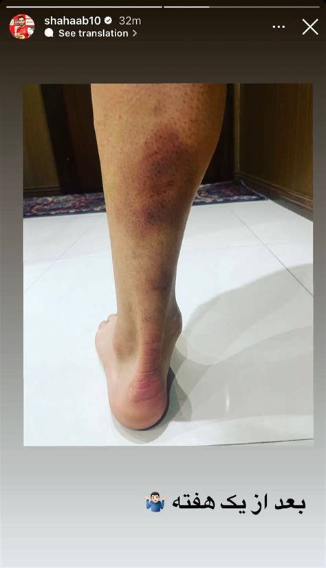 خبرآنلاین عکس‌ اعتراض خلاقانه یک پرسپولیسی؛ رونمایی از تصویر کبودی
