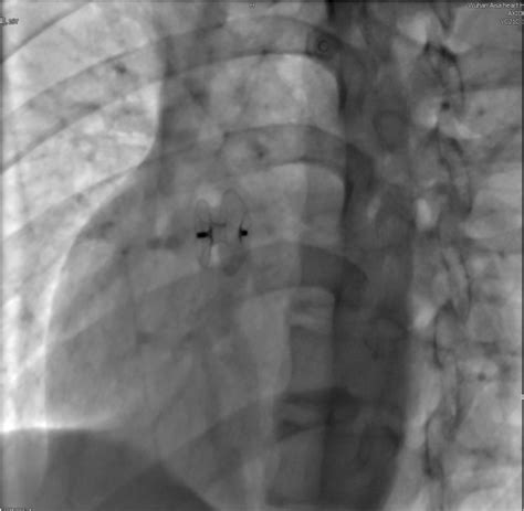 The Patient Successfully Underwent Cardiac Catheterization And Device