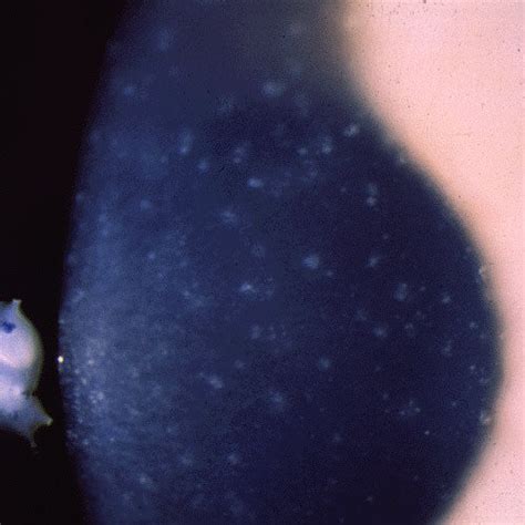 Lattice Corneal Dystrophy Type I Variant Deposits Of Amyloid