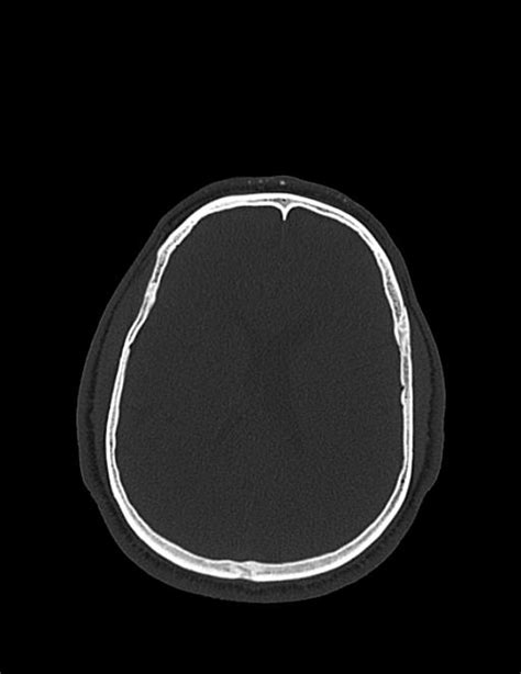 Calcified Acne Lesions Miliary Osteoma Cutis Radiopaedia 44050 47577