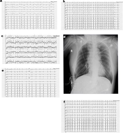 A The ECG Showed Sinus Rhythm HR 98 Bpm Frequent Atrial Premature