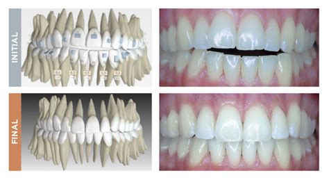Ormco Spark™ Innovative And Advanced Clear Aligner System