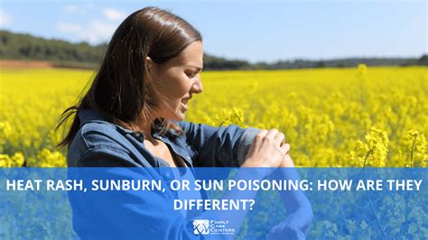 Differences Between Sunburn Sun Poisoning Heat Rash Heat 50 Off
