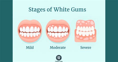Best Toothpastes To Remineralize Teeth Naturally 2025