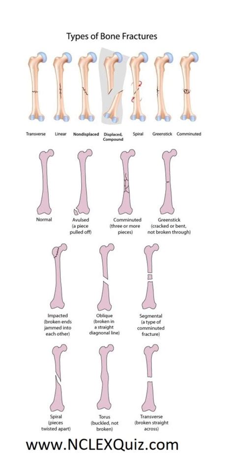 Types Of Bone Fractures Studypk
