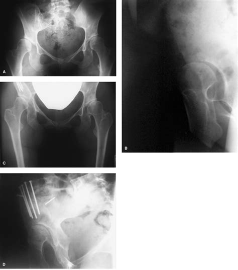 Pip Joint Dislocations Teachme Orthopedics