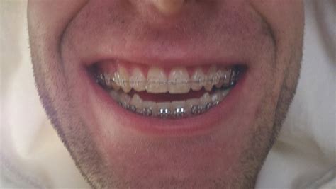 Bracesopen Bite Surgery Wisdom Teeth Gone