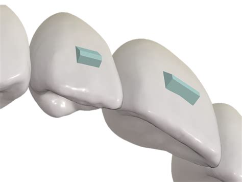 Engagers Also Known As Attachments Clearcorrect Support