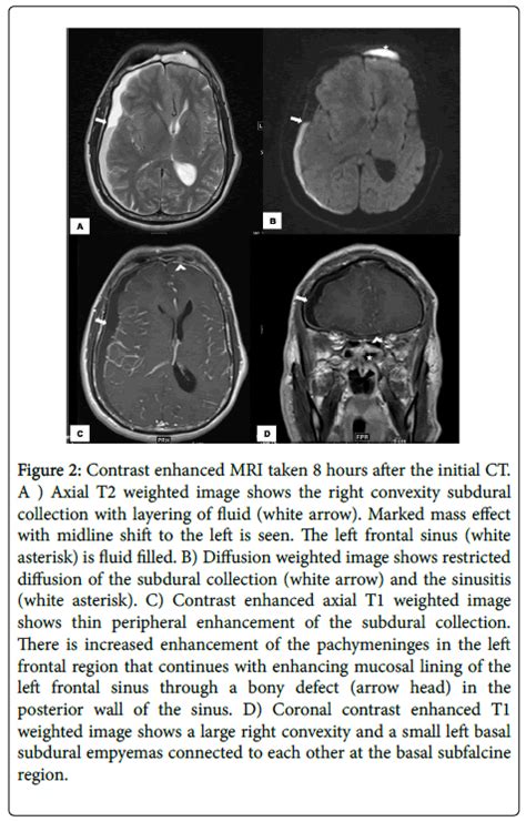 Rapidly Developing Subdural Empyema In An Adult With Sinusitis A