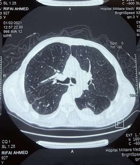 Mass Along The Left Posterior Pleural Surface Download Scientific Diagram