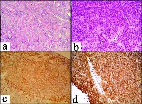 Spindle Cell Proliferation With Myxoid Stroma At Minh Boser Blog