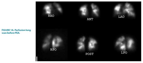 perfusion lung scan after pulmonary artery endarterectomy in patients