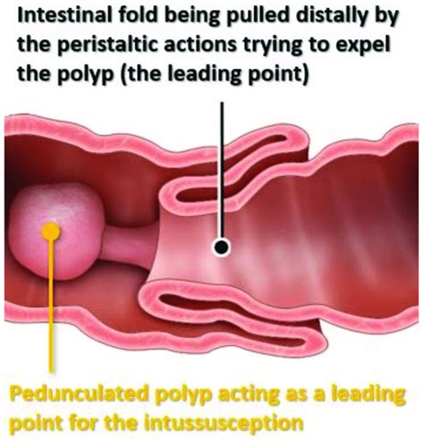 Diagrammatic Illustration Of Pjs Git Polyp As The Leading Point Of
